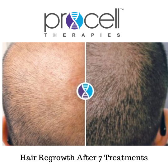 Procell Hair Restoration - Fitness Incentive